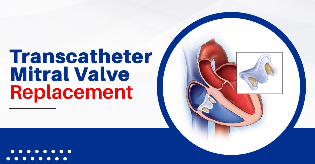 Transcatheter Mitral Replacement TMVR Healingvalves Transcatheter Mitral Replacement TMVR Healingvalves